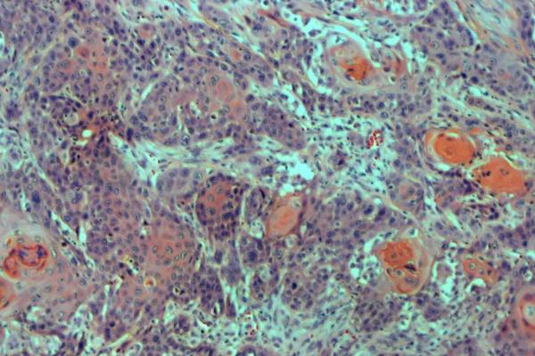 The Rockefeller University » Research on rare genetic disease sheds ...